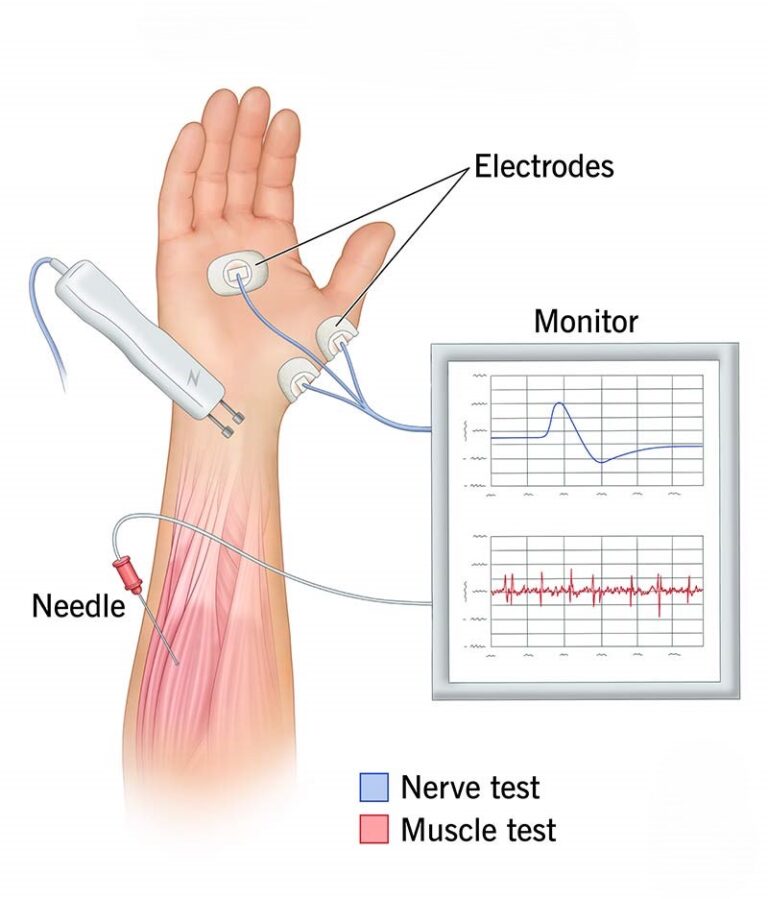 Electromyography (EMG) Testing - Orthopedic Specialists of SW Florida